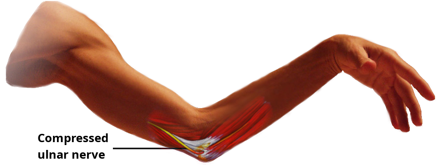 Cubital Tunnel Syndrome – The Nerve Surgery Centre